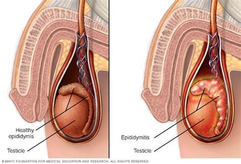 Epididymis Swollen