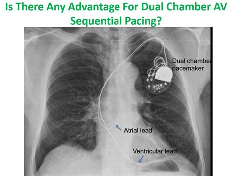 Is There Any Advantage For Dual Chamber Av Sequential Pacing All About Heart And Blood Vessels