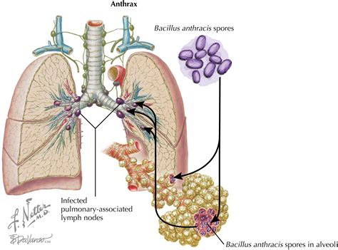 Anthrax Clinical Tree