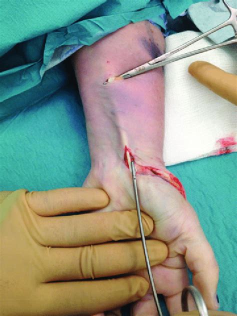 Harvested Radial Half Of Fcr Tendon Download Scientific Diagram