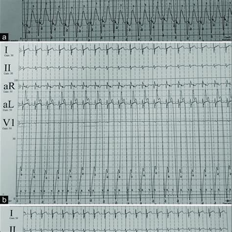 A Increased Basal Left Ventricular End Diastolic Pressure 14 Mmhg Download Scientific