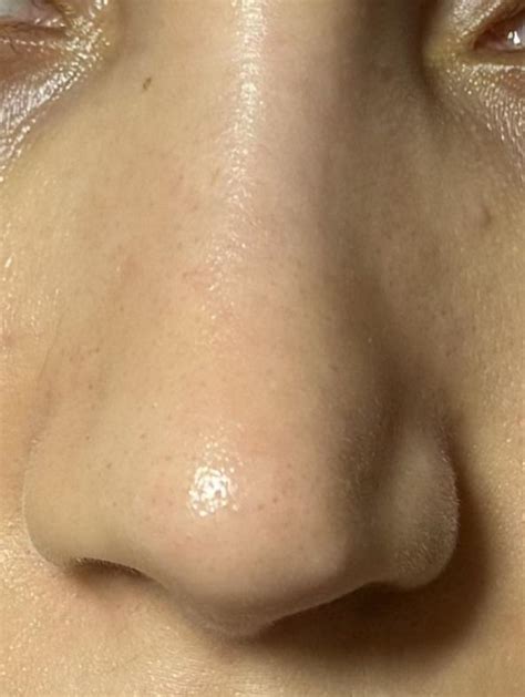 6 Weeks Post Septorhinoplasty Scrolller