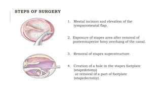 Clinical Profile Diagnosis And Management Of Otosclerosis Pptx