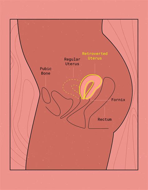 Whats A Retroverted Uterus The Fornix Flex