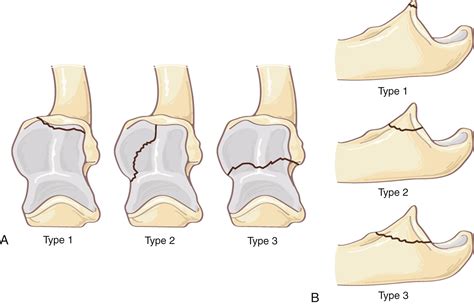 Coronoid Fractures And The Terrible Triad An Algorithm For Successful Management Clinical Tree