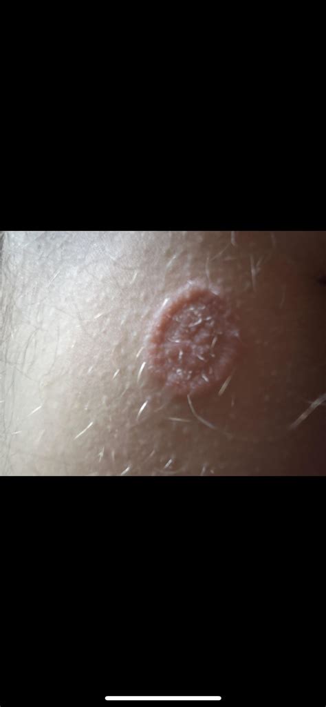 Is This Rash Bump Related To Lyme Disease Or Something Else R