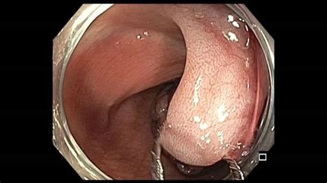 Pedunculated Polyp