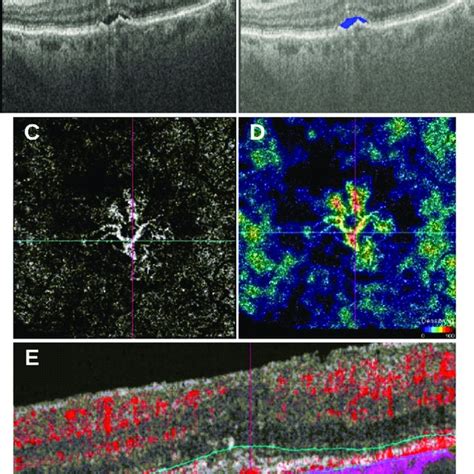 A SS OCT Volume Scan Of 87 Year Old Female Patient With Type I CNV Download Scientific