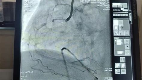 Kiran Kumar Reddy On Linkedin Planned Orbital Atherectomy Able To Ablate Proximal Rca Calcium