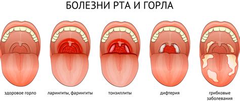 Неприятный запах изо рта