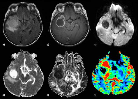 Figure 1 From C Artifacts In Perfusion And Diffusion MRI Semantic Scholar