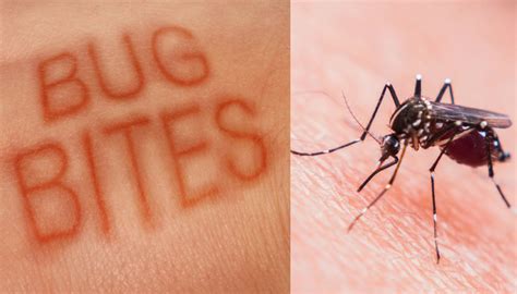 Natural Ways To Treat Bug Bites And Stings Mother Of Health