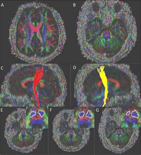 Axial Color Coded Fractional Anisotropy Map Demonstrating The