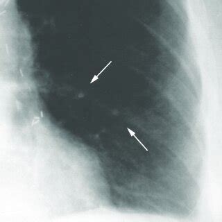CT Scan Of The Chest Revealing Diffuse Interstitial Fibrosis Arrows Download Scientific Diagram