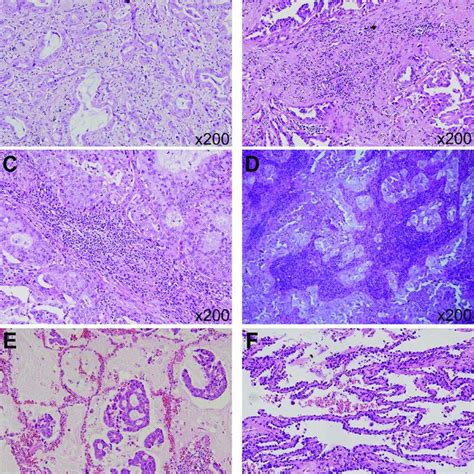 Assessment Of Tumor Infiltrating Lymphocytes Tils Level A 5 Of