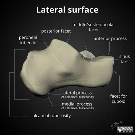 Calcaneus Fracture The Lovers Fracture — Kwak Talk