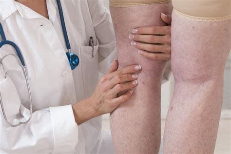 Edema En Las Piernas Síntomas Y Tratamiento Sanitas