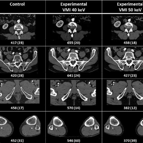 Lower Extremity Cta In The Control Group And In The Experimental Group Download Scientific