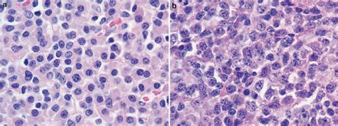Note The Frank Plasmacytic Differentiation With Classic Plasma Cells Download Scientific