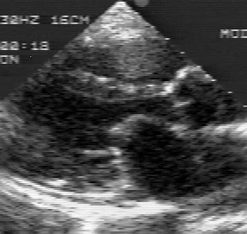 Echocardiography