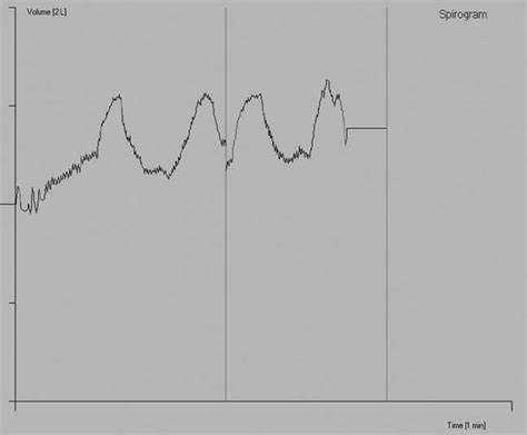 Volume Time Spirogram Revealed A High Frequency Wave Pattern