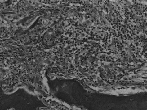 Computed Tomography Showing Compression Of The Left L3 Nerve Root By Download Scientific
