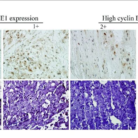 Assessment Of Cyclin E1 Expression In The Chordoma Tissue Microarray