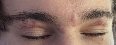 18 Yo Male Clustered Pustular Lesions On Bilateral Eyelids X 9 Months Rest Of Face Is