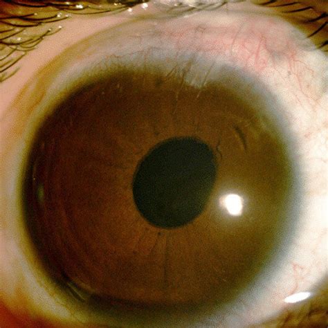 Anterior Segment Photograph Of The Patients Right Eye Taken One Month Download Scientific