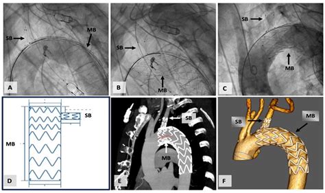 A Type B Aortic Dissections With False Lumen Fl And True Lumen Tl