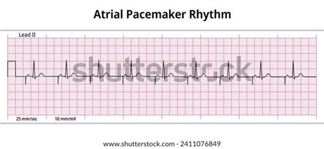 Ecg Atrial Pacemaker Rhythm Single Chamber Stock Vector Royalty Free