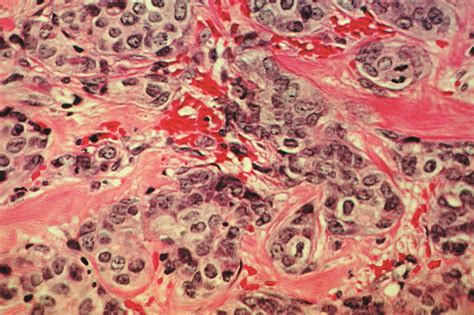 Ten Years Of Hormone Therapy Cuts Breast Cancer Recurrence The