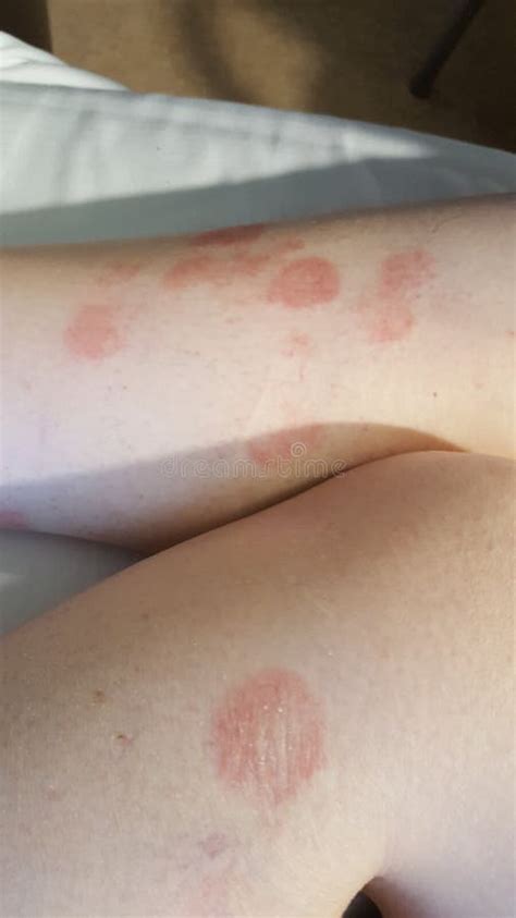 Erythema Multiforme Annular Erythematous Targetoid Skin Lesions Stock