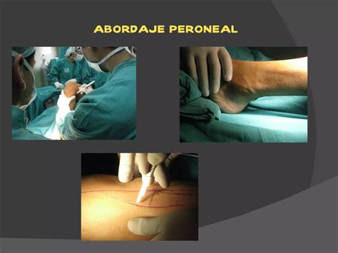 Reconstruccion Mandibular Con Injerto Libre Microvascularizado De