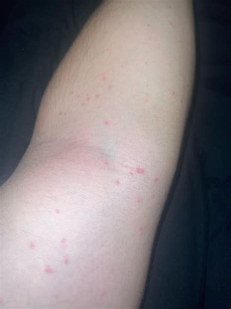 Need Help Identifying R Scabies