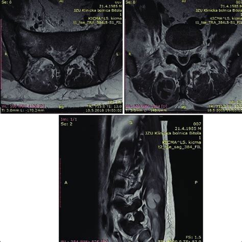 Magnetic Resonance Imaging Of The Lumbar Spine And Pelvic Region