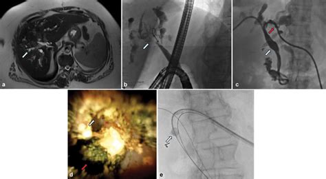 Atlas For Cholangioscopy And Cholecystoscopy A Primer For Diagnostic