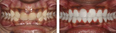 Treatment Information Snodgrass King Orthodontics