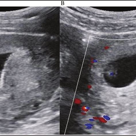 A Ultrasound Image Of Gestational Sac At Transverse View Showed Download Scientific Diagram