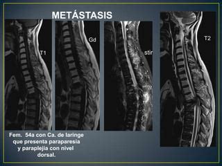 Lesiones Medulares Pptx