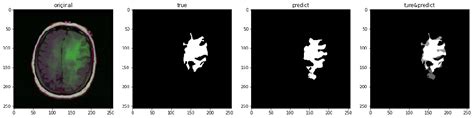 github kurisuzhang cnn for brain lesion segmentation in mri images