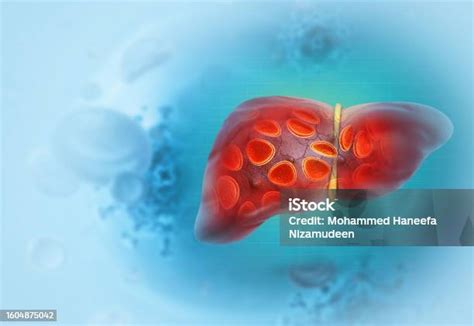 지방간 섬유증 간경변 및 간암과 같은 간 손상 3d 일러스트레이션 3차원 형태에 대한 스톡 사진 및 기타 이미지 3차원 형태 간 내부 기관 간암 Istock