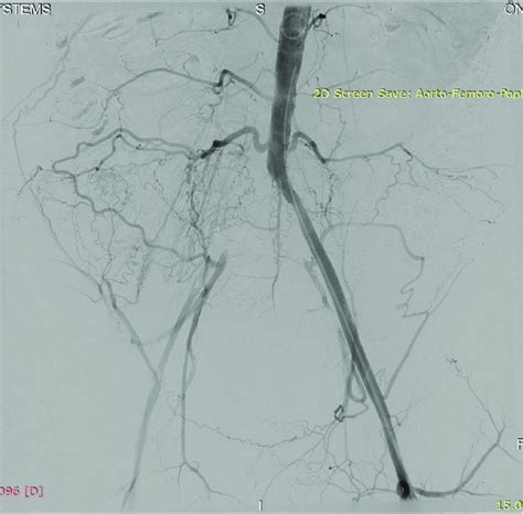 Angiogram Image Of Patient Before Hybrid Revascularization Common And Download Scientific