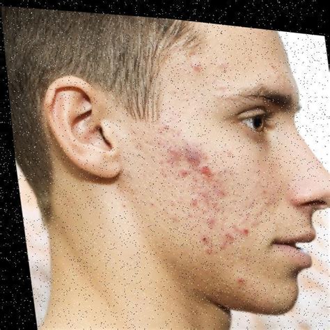 Yolov8 Acne Detection Object Detection Model By Dermatologiaestoril