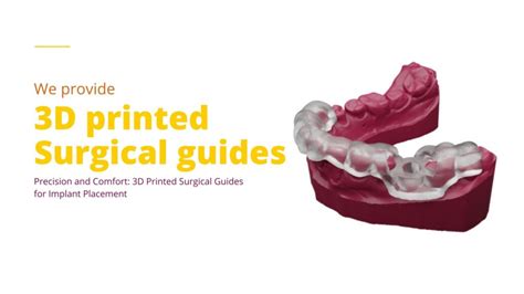 Precision And Comfort 3d Printed Surgical Guides For Implant Placement Radix Reports And 3d Prints