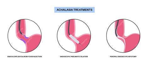 Premium Vector Achalasia Treatments Minimally Invasive Procedures Closed Lower Esophageal