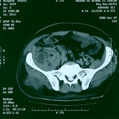 Section Of The Appendix Hyperplasia Of The Lymphatic Tissue Is Evident Download Scientific Section Of The Appendix Hyperplasia Of The Lymphatic Tissue Is Evident Download Scientific