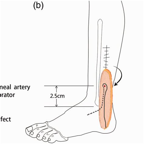 Schematic Diagram Of Flap Cutting And Correct Rotation Direction The Download Scientific