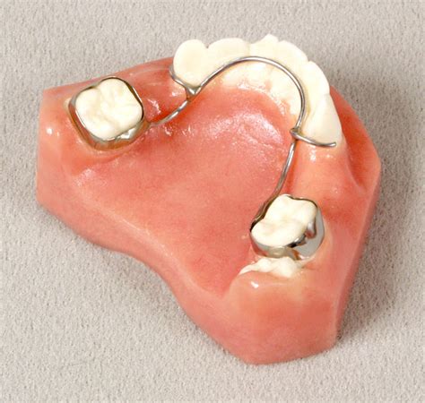 What Are Spacers For Teeth