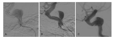 Figure 1 From Pipeline Embolization Device For Salvage Treatment Of A Willis Covered Stent